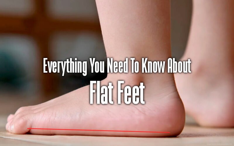 Everything You Need To Know About Flat Feet - Your Body Posture